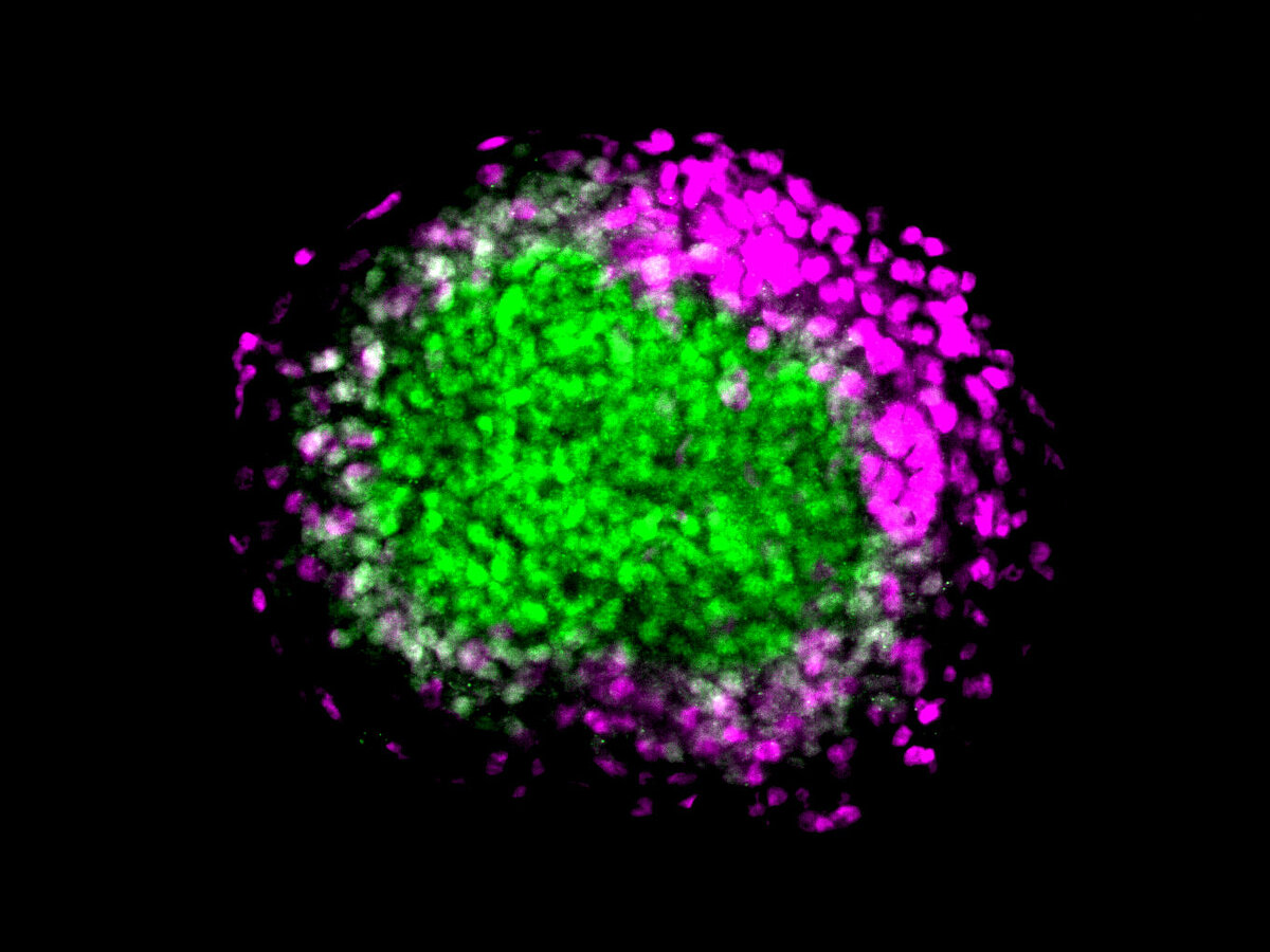 Weiss-Kruszka syndrome and the failure to establish neuronal identity